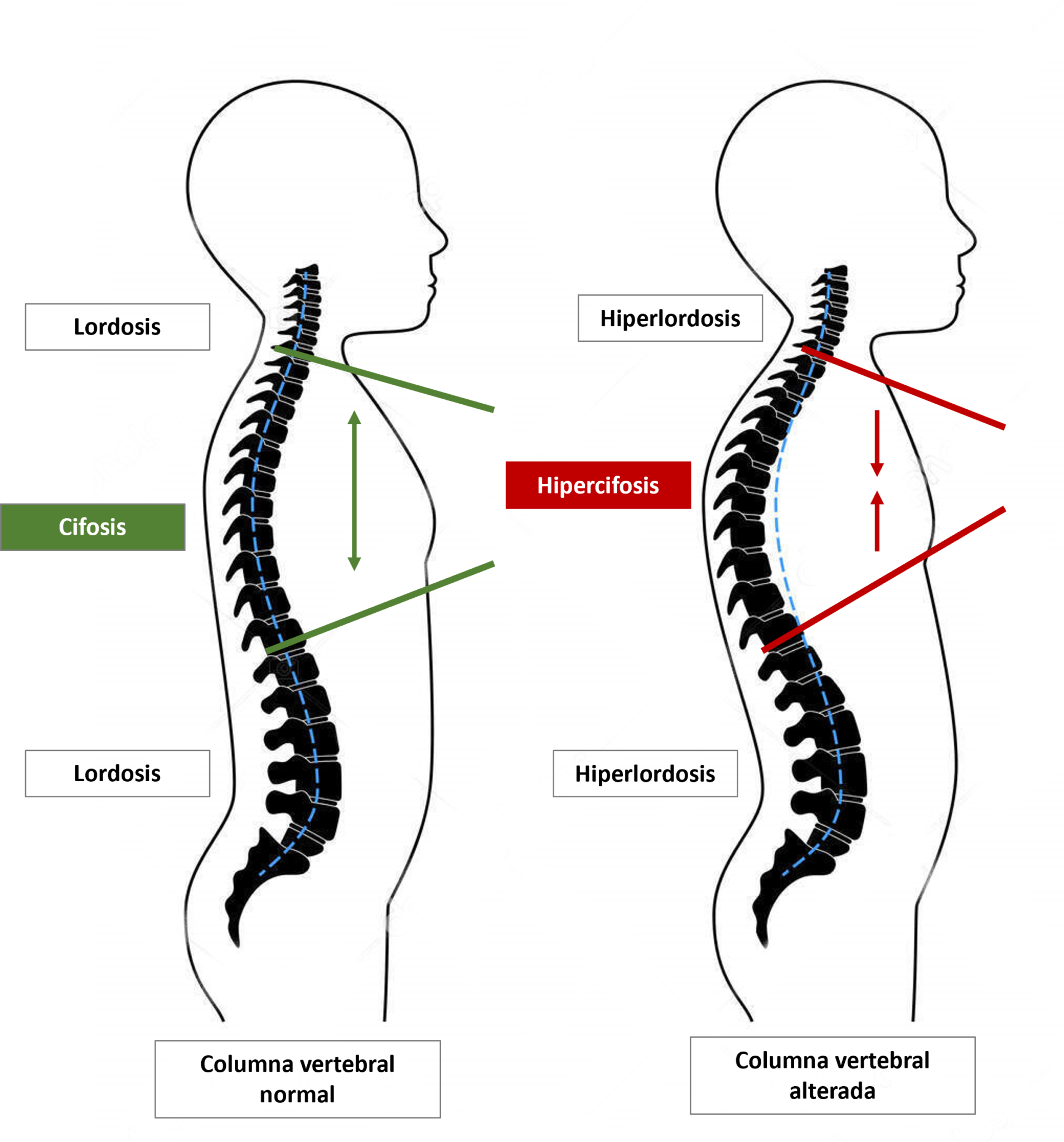 Cifosis - IGM Ortopedia
