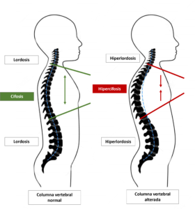 Cifosis - IGM Ortopedia