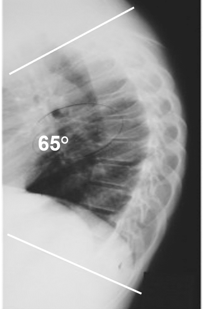 Cifosis - IGM Ortopedia